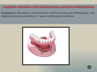 tongue and its prosthodontic considerations | PPTX