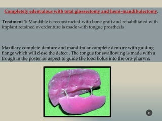 TONGUE ITS ANATOMY DEVELOPMENTAL ANOMALIES AND PROSTHODONTIC ...