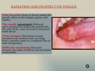 TONGUE ITS ANATOMY DEVELOPMENTAL ANOMALIES AND PROSTHODONTIC ...