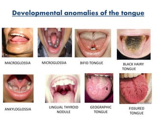 Tongue development,anatomy,prosthetic consideration | PPT