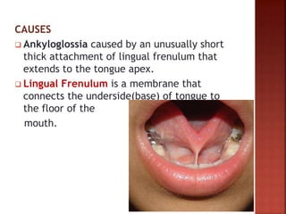 TONGUE-DISORDERS.pptx