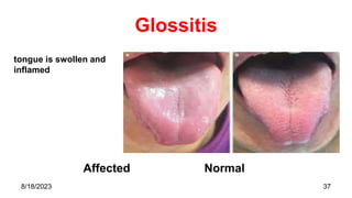 tongue and hypoglossal nerve.ppt