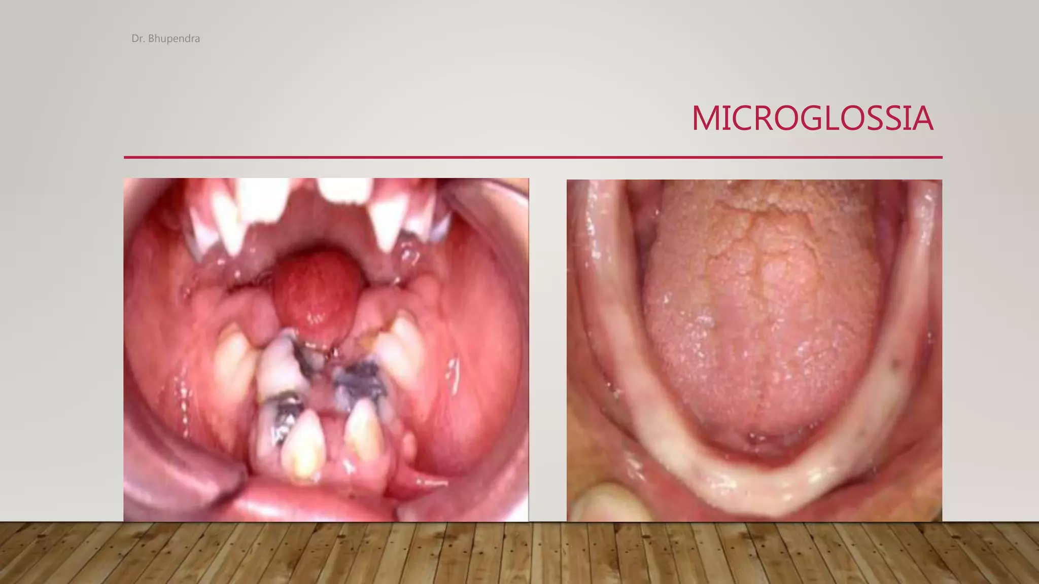 Tongue and its prosthodontic considerations | PPTX