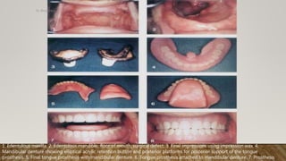 Tongue and its prosthodontic considerations | PPTX