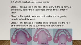 Tongue and its prosthodontic considerations | PPT