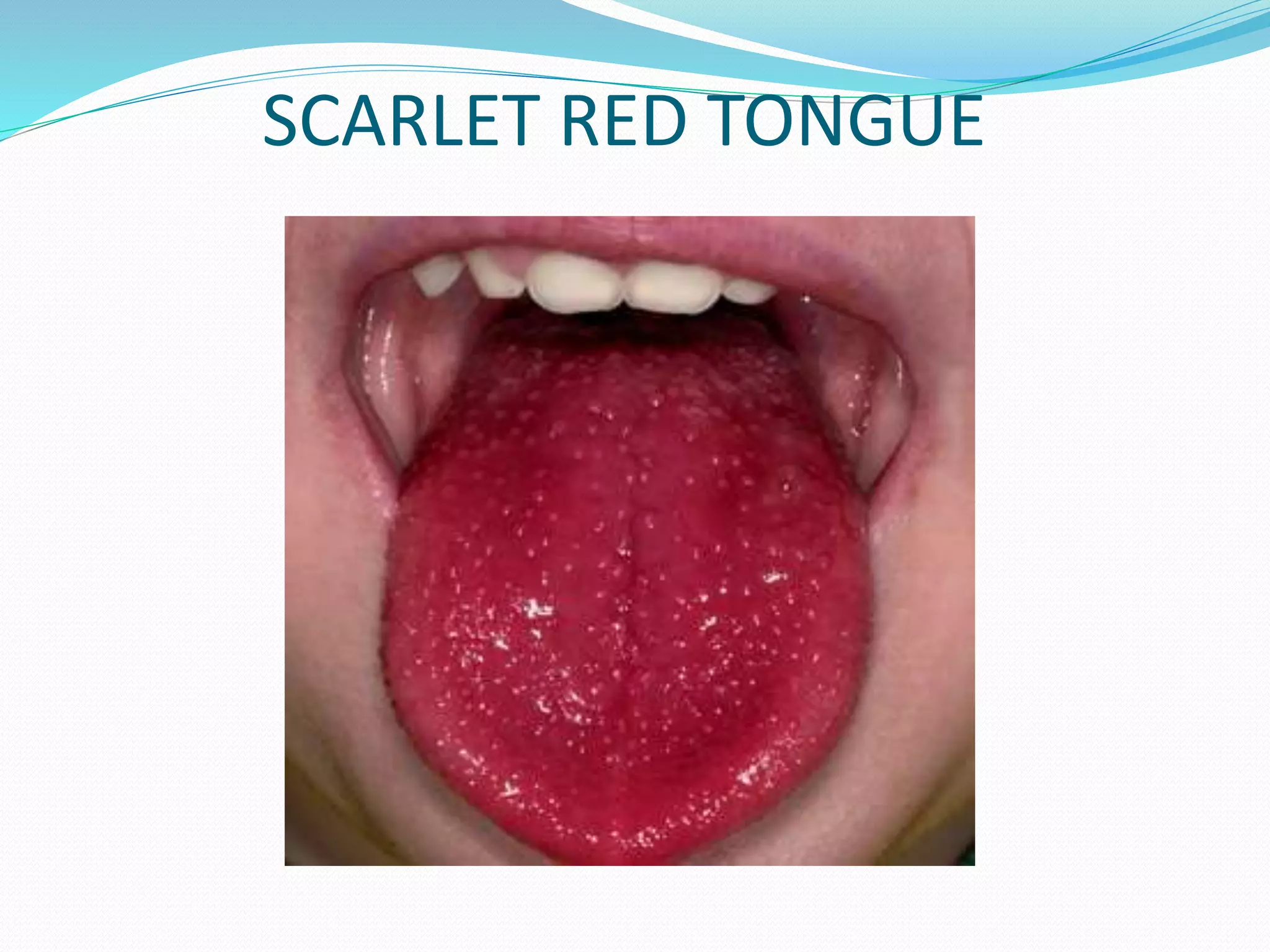 Tongue and systemic diseases | PPTX