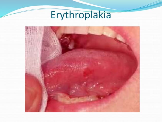 Tongue and systemic diseases | PPTX