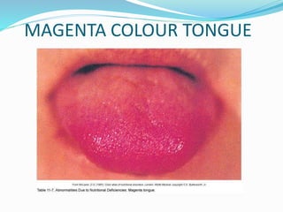 Tongue and systemic diseases | PPT