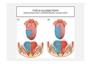 Tongue Carcinoma- basic surgical knowledge | PDF