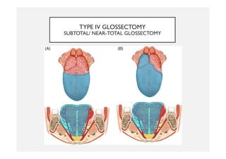 Tongue Carcinoma- basic surgical knowledge | PDF