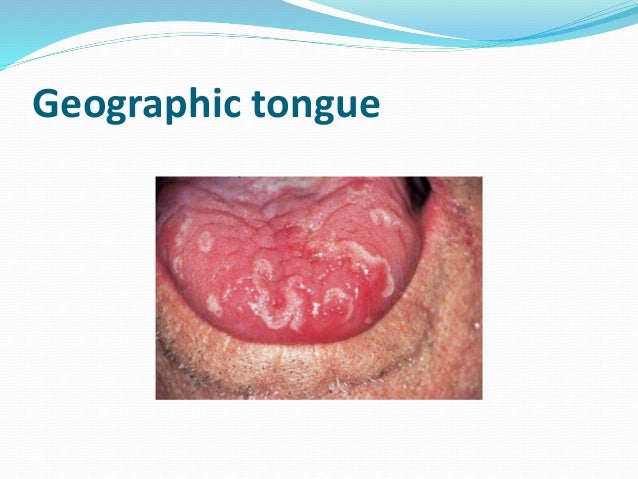 Tongue Diseases