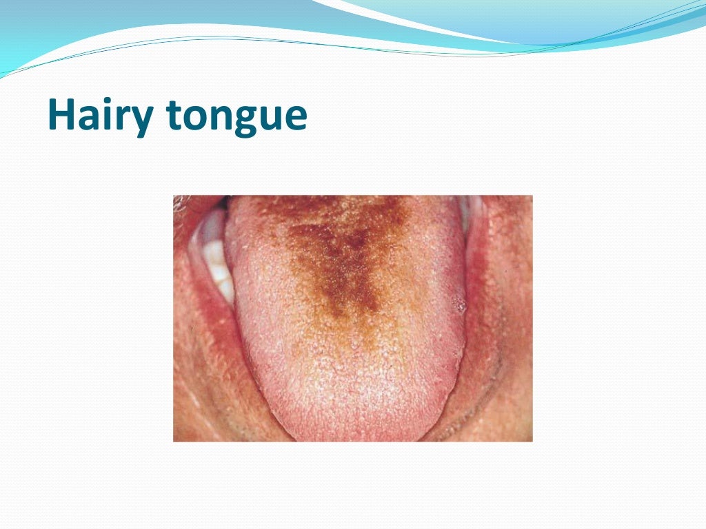 Tongue Disorders