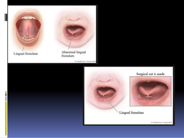 Tongue disorders