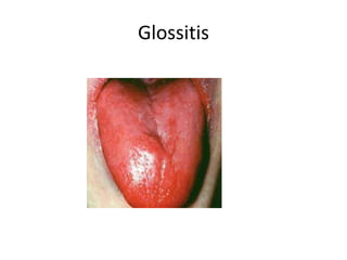 Tongue disorders | PPTX