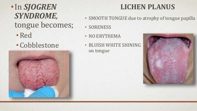 Tongue Disorders