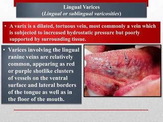 Lingual Varicosities