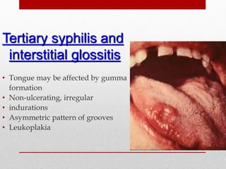 Syphilitic Glossitis