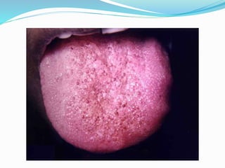 Diseases Of Tongue Pptx