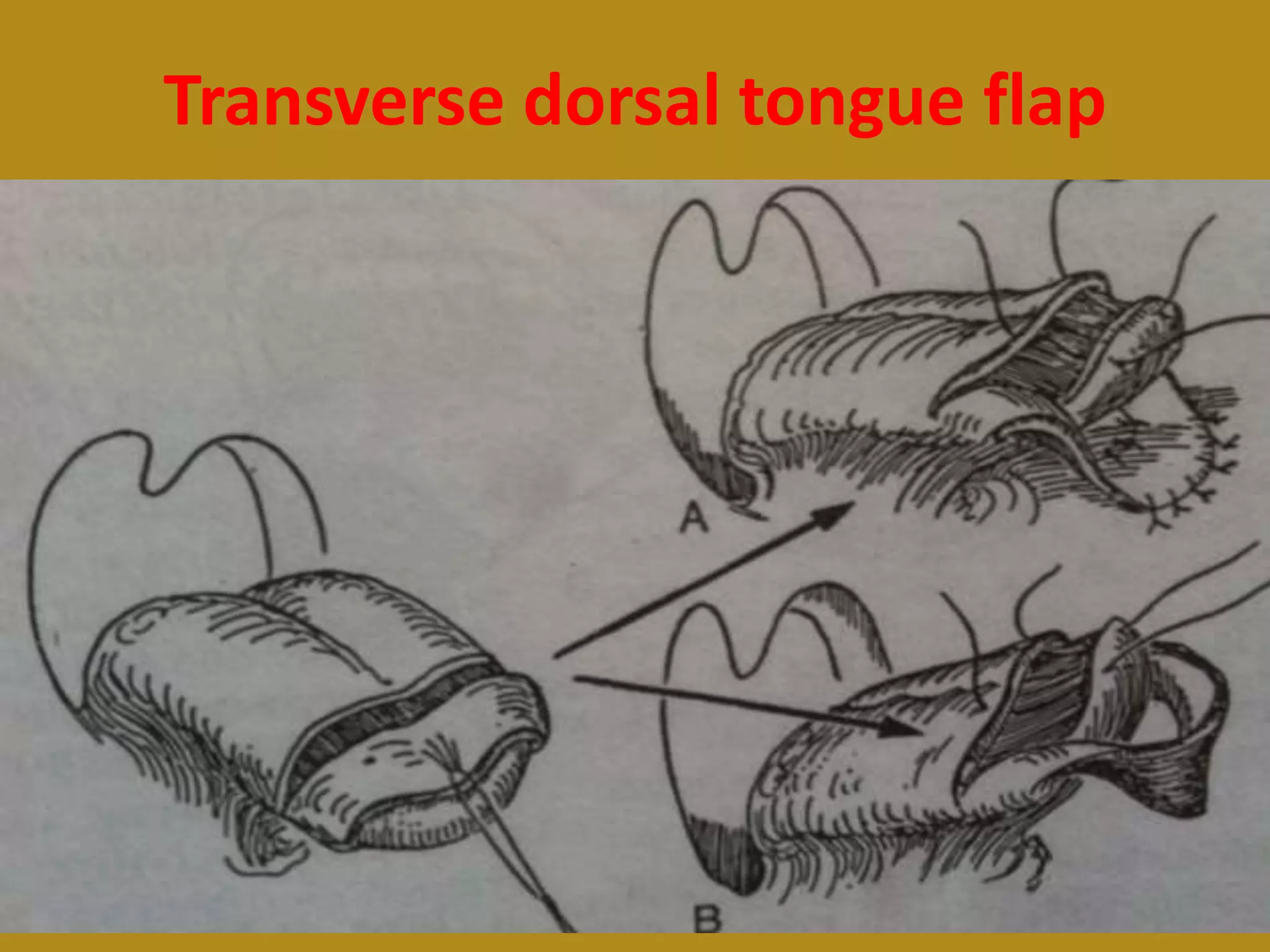 Tongue Flaps | PPTX