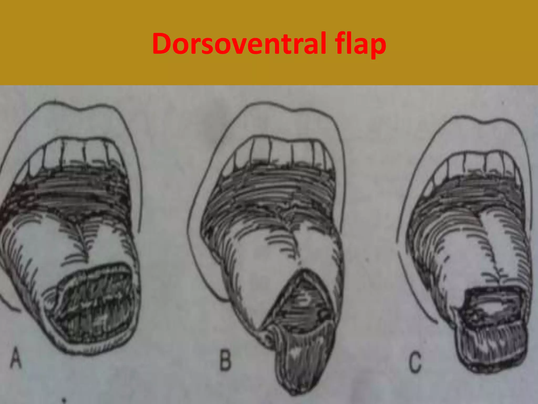 Tongue Flaps | PPTX