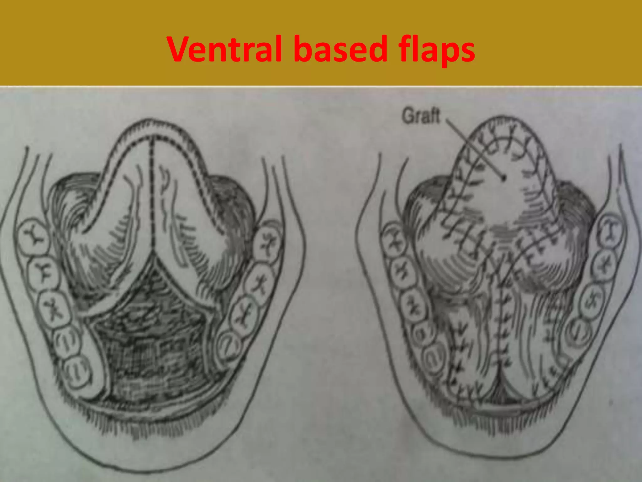 Tongue Flaps | PPTX