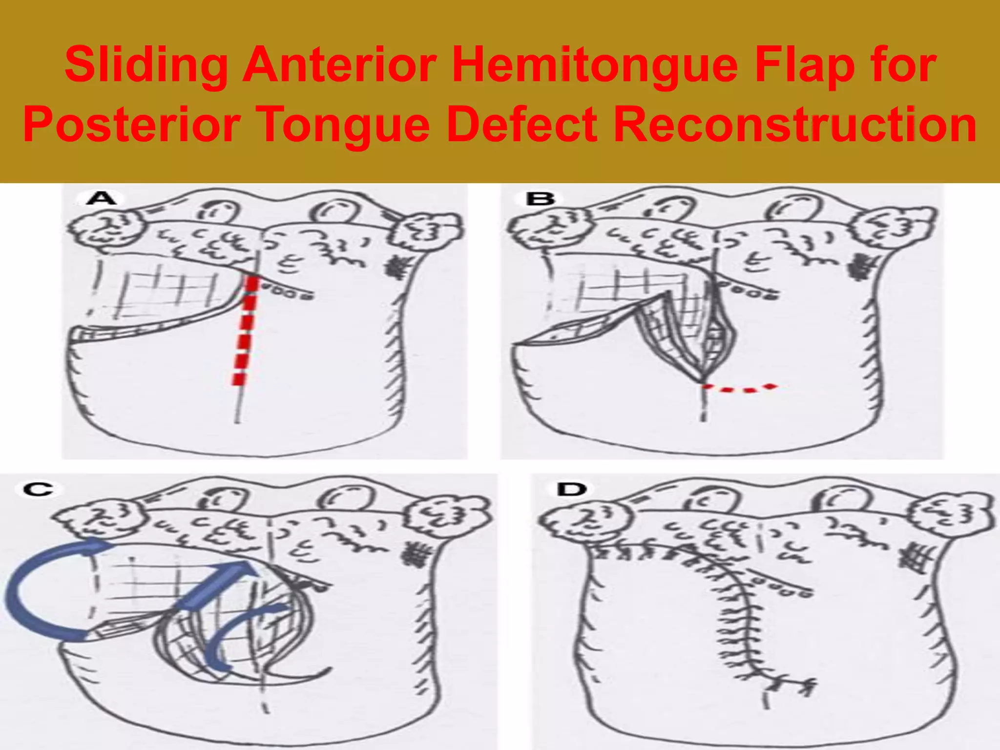 Tongue Flaps | PPTX