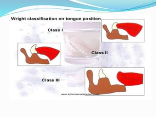 Tongue & its prosthetic coniderations seminar | PPT