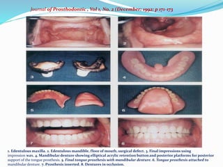 Tongue & its prosthetic coniderations seminar | PPT