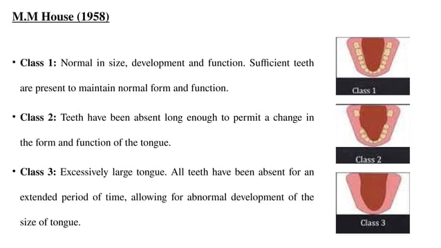Tongue and Its Implications in Prosthodontics .pptx
