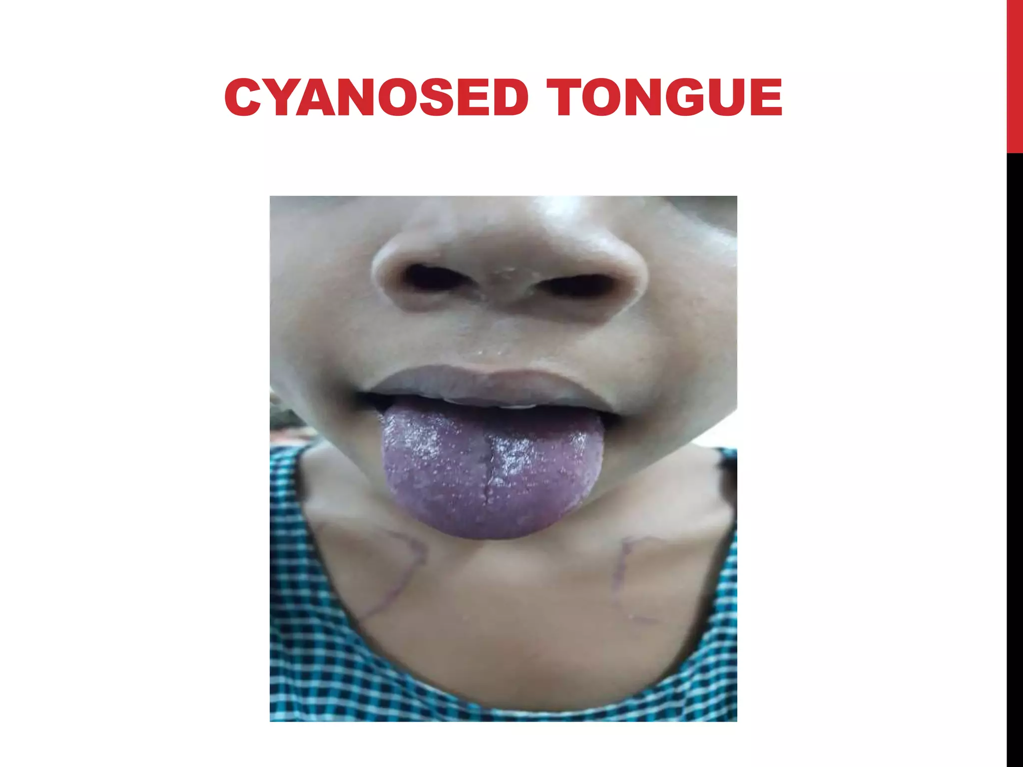 Tongue in health and disease | PPTX