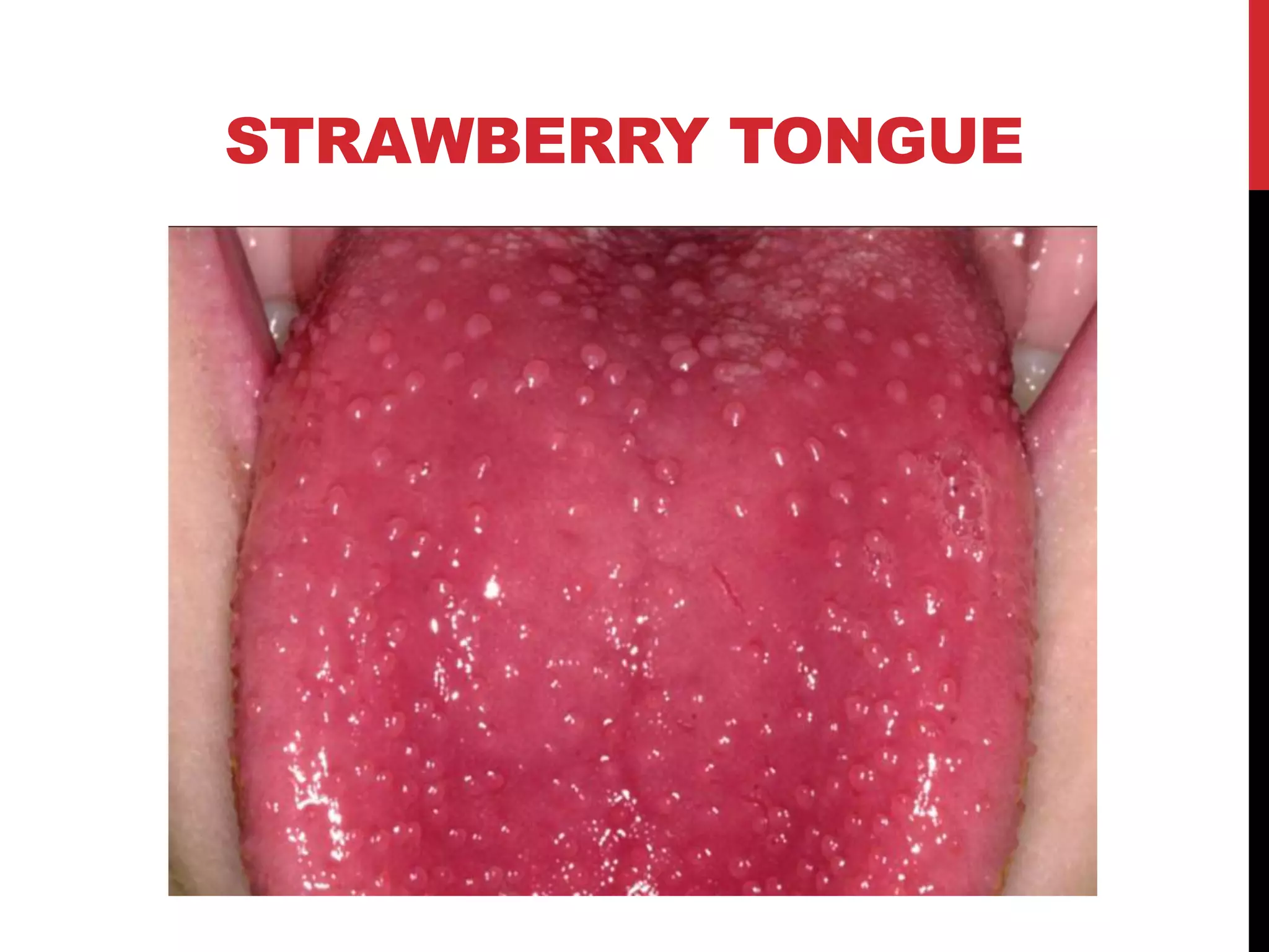 Tongue in health and disease | PPTX