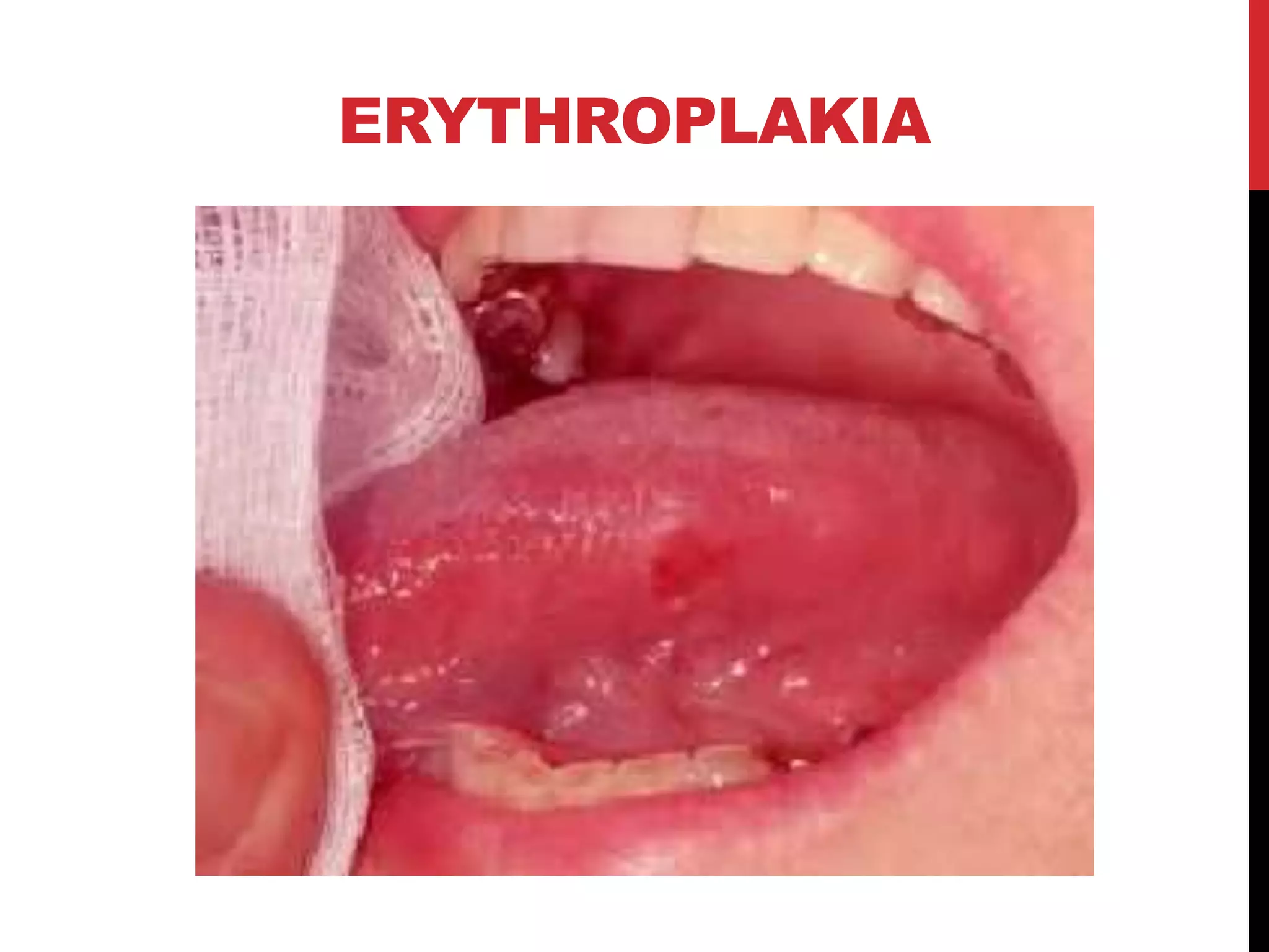 Tongue in health and disease | PPTX