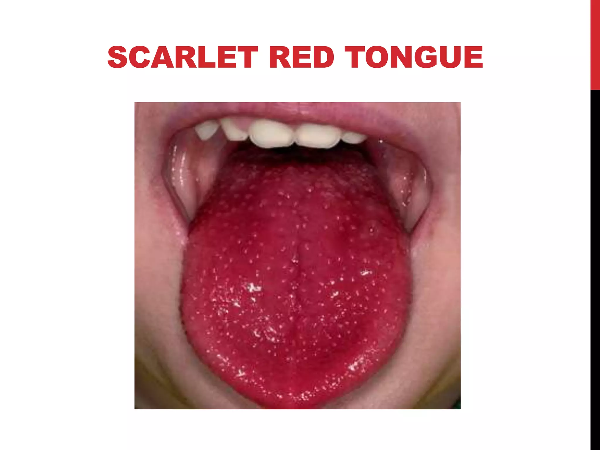 Tongue in health and disease | PPTX