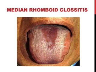 Tongue in health and disease | PPTX