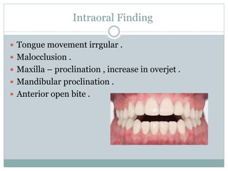 Tongue thrust | PPTX