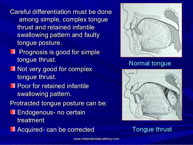Tongue thrusting habit & other habits ,its management 2 /certified f…