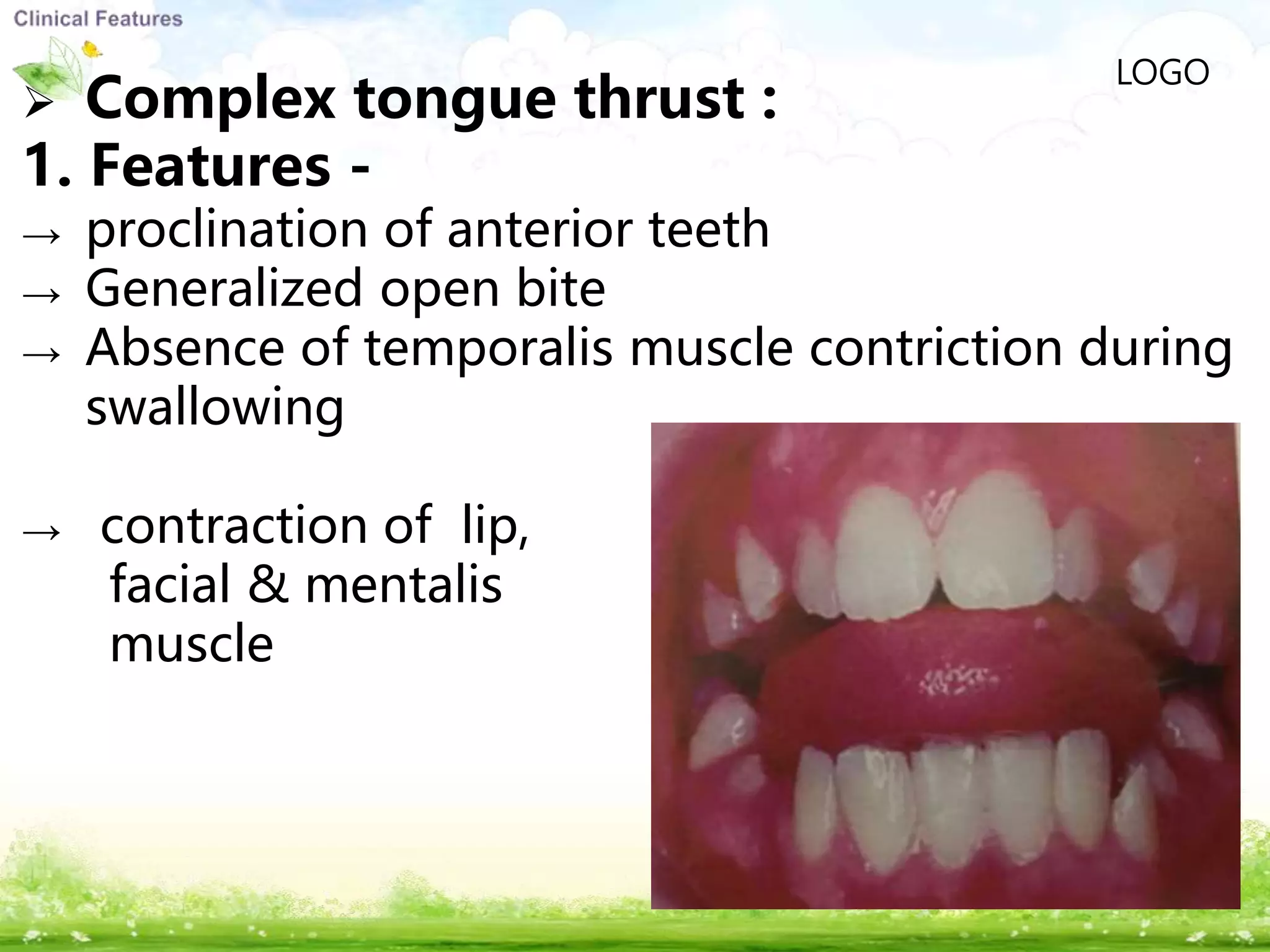TONGUE THRUSTING HABIT | PPTX