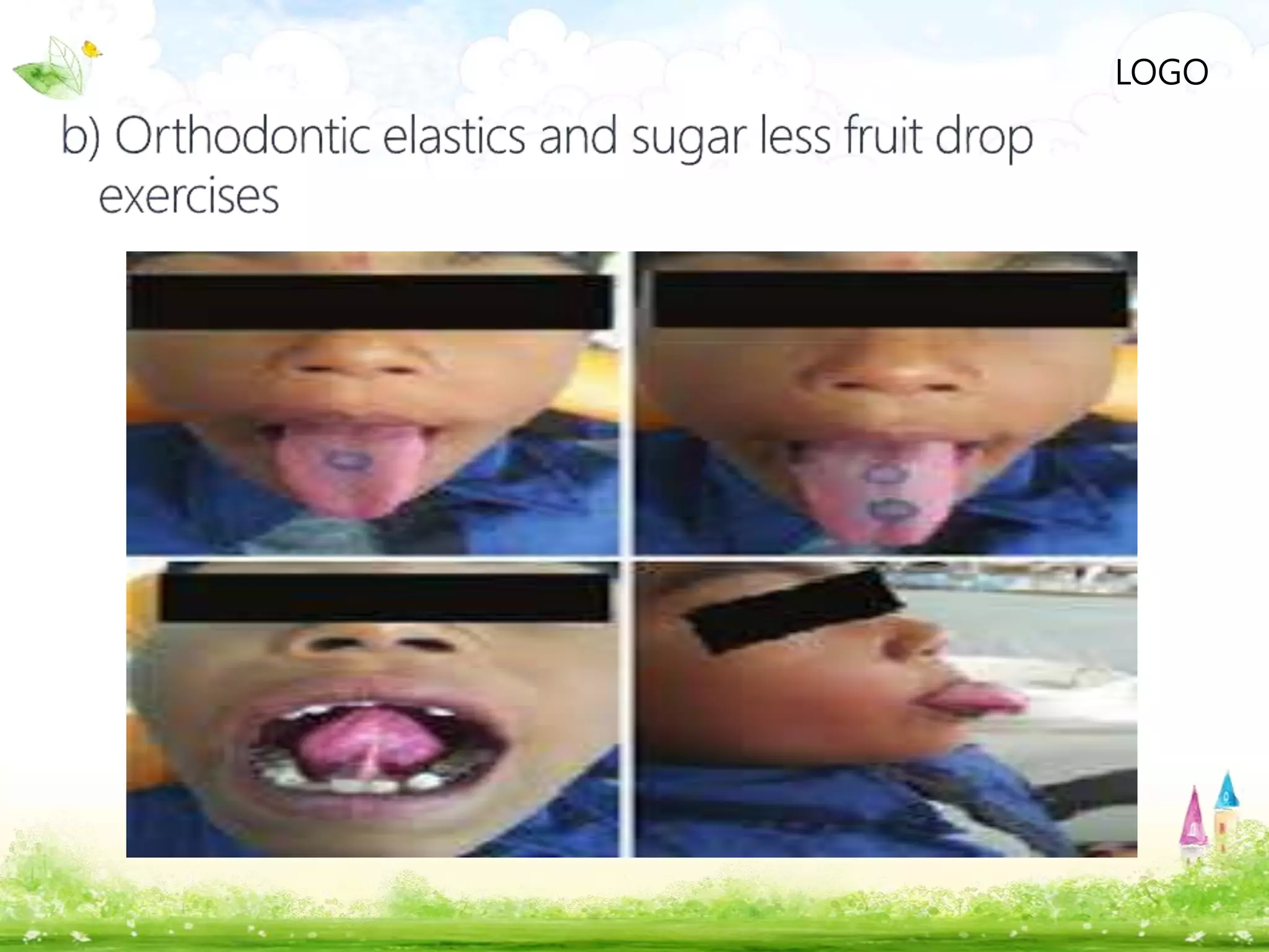 TONGUE THRUSTING HABIT | PPTX