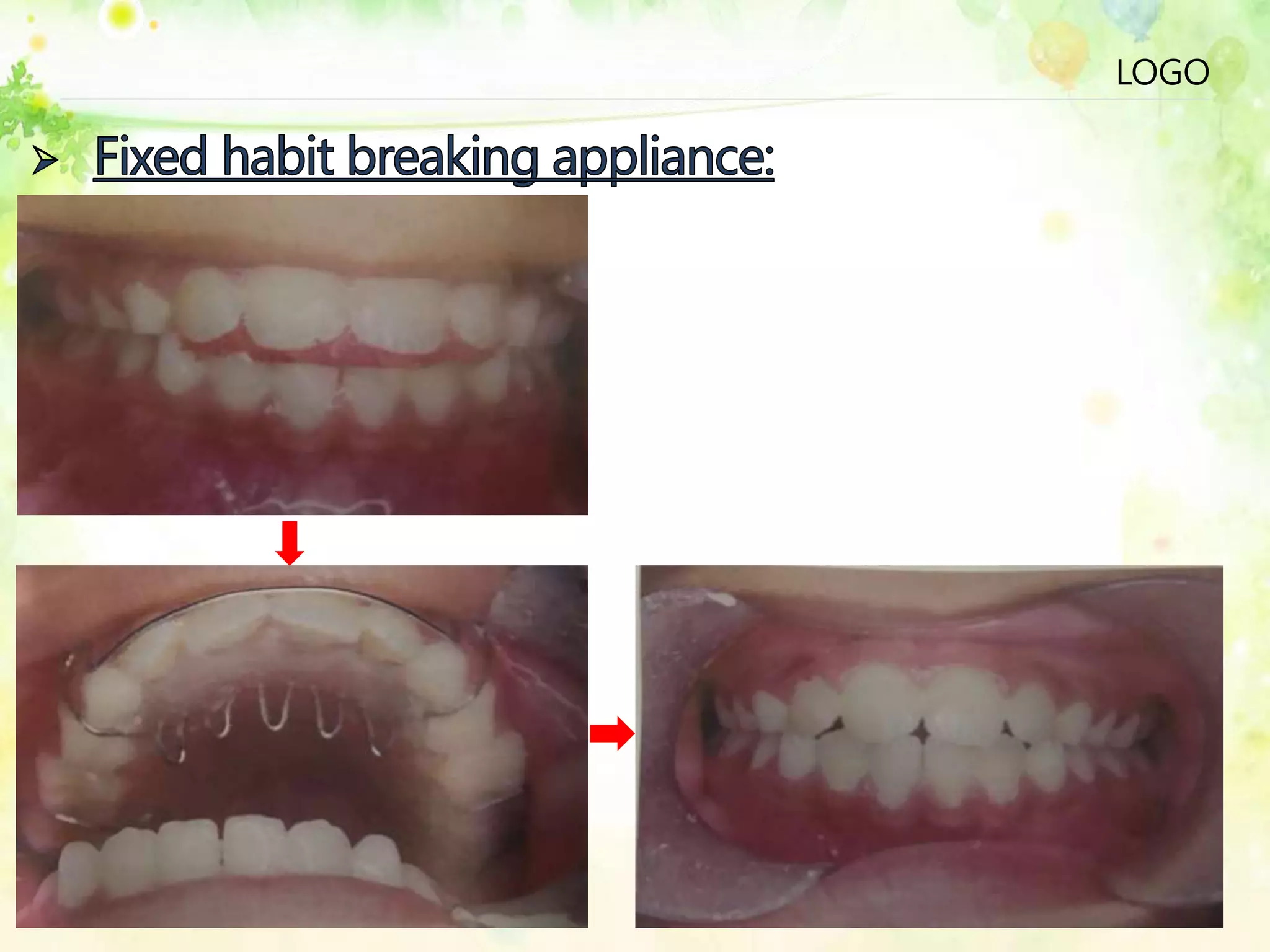 TONGUE THRUSTING HABIT | PPTX