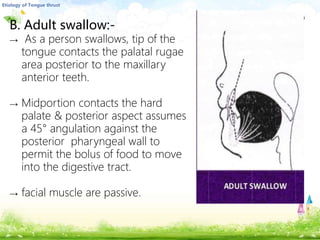 TONGUE THRUSTING HABIT | PPTX