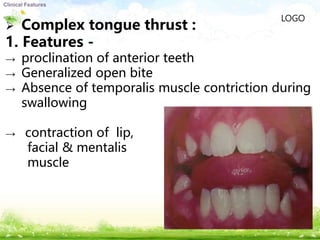 TONGUE THRUSTING HABIT | PPTX