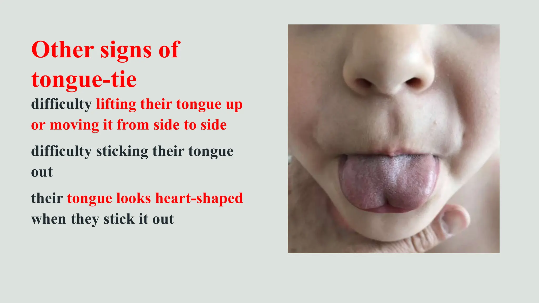 Tongue tieDiagnosis and mangement .pptx