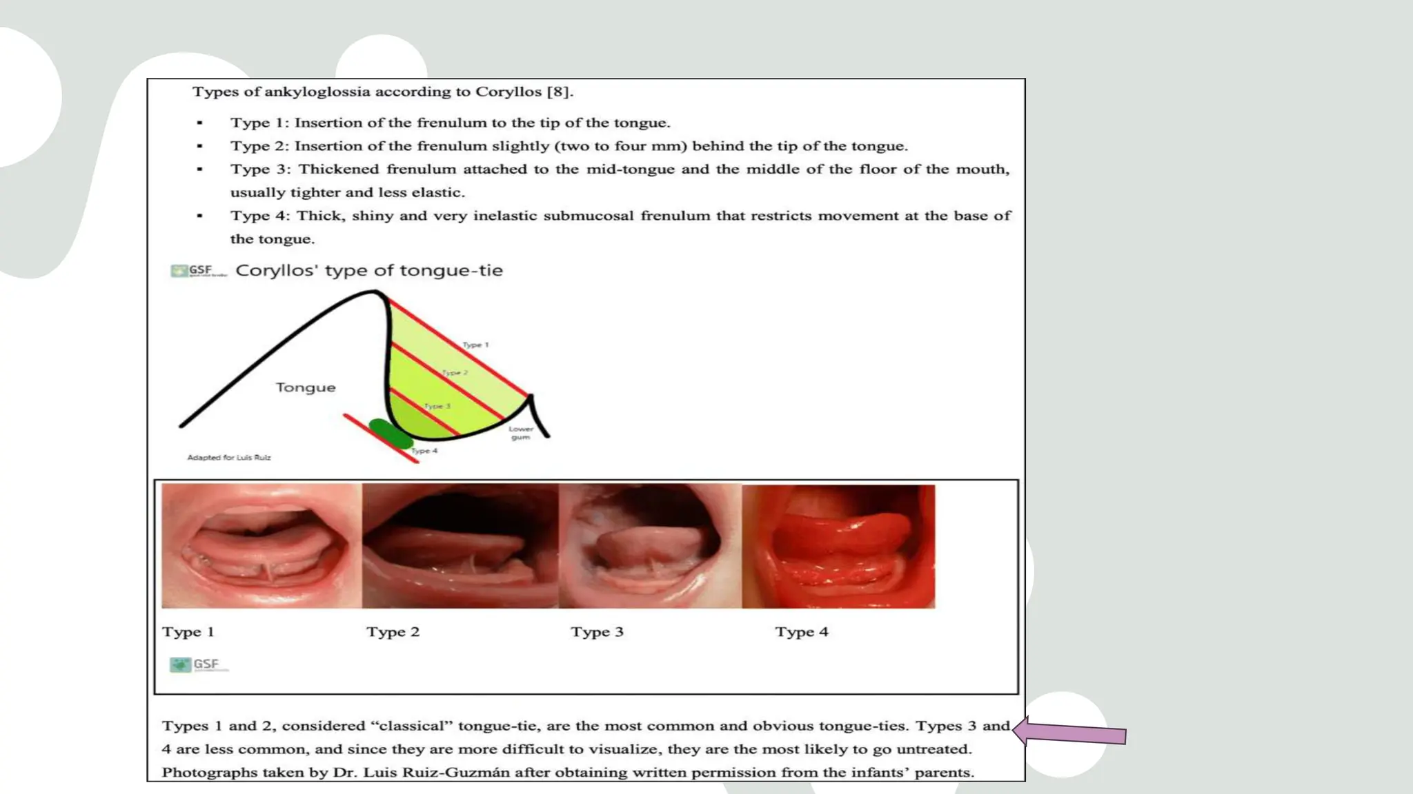 Tongue tieDiagnosis and mangement .pptx