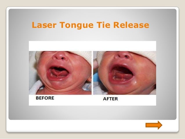 Tongue Tie Surgery Laser Frenectomy Cost Tongue Tie Sydney