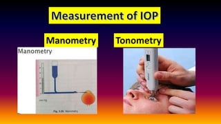 Tonometer | PPT