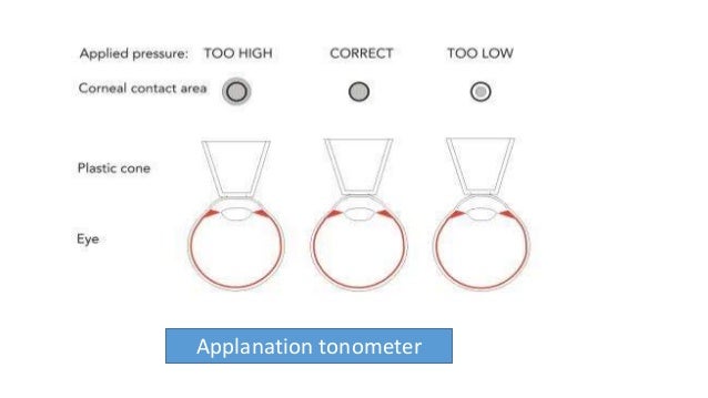 Tonometry