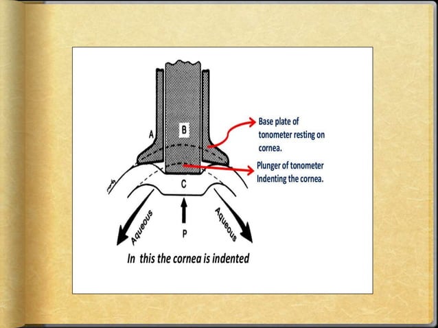 Different types of Tonometry | PPTX | Eye and Vision Conditions ...
