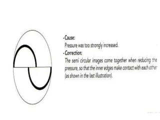 Tonometry and tonography | PPT