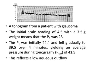 Tonometry and tonography | PPT