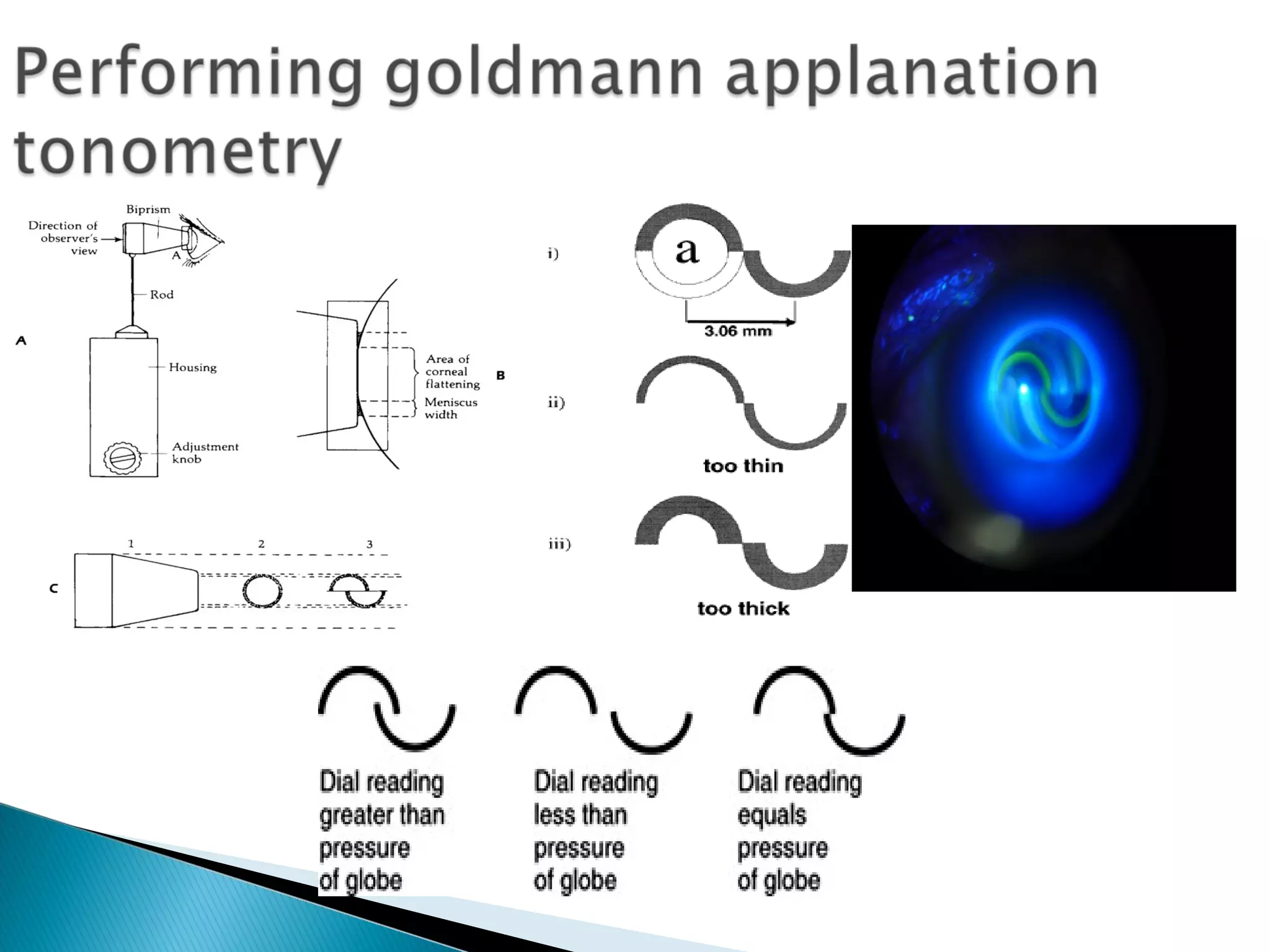Tonometry by dr. mamta meena | PPT